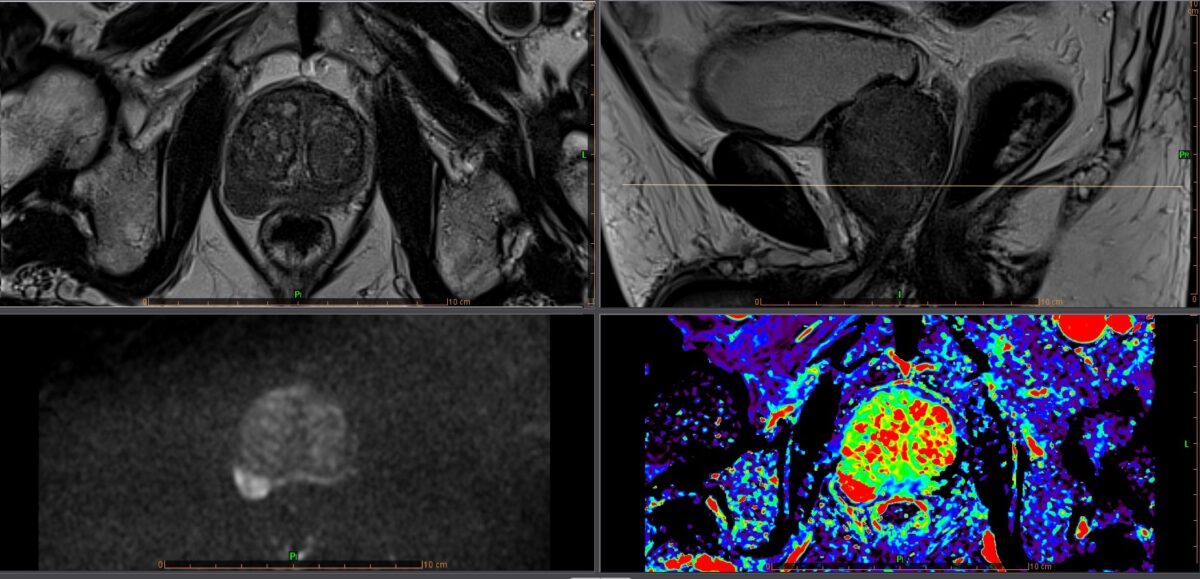 Prostatakrebs-Früherkennung im MRT - Privat Radiologie Regensburg
